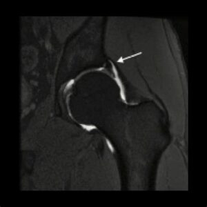 Rotura de Labrum: Una Lesión Frecuente y Subestimada – Kentro
